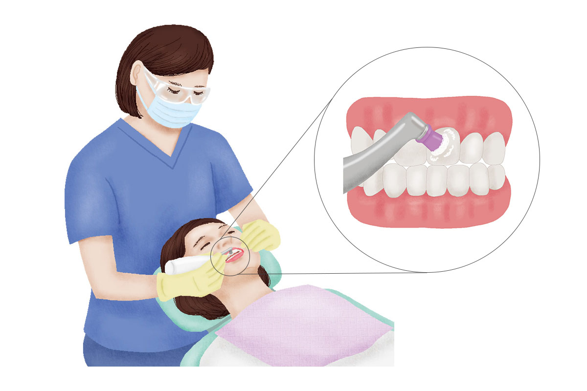 PMTC(Professional Mechanical Tooth Cleaning) | 歯科用語